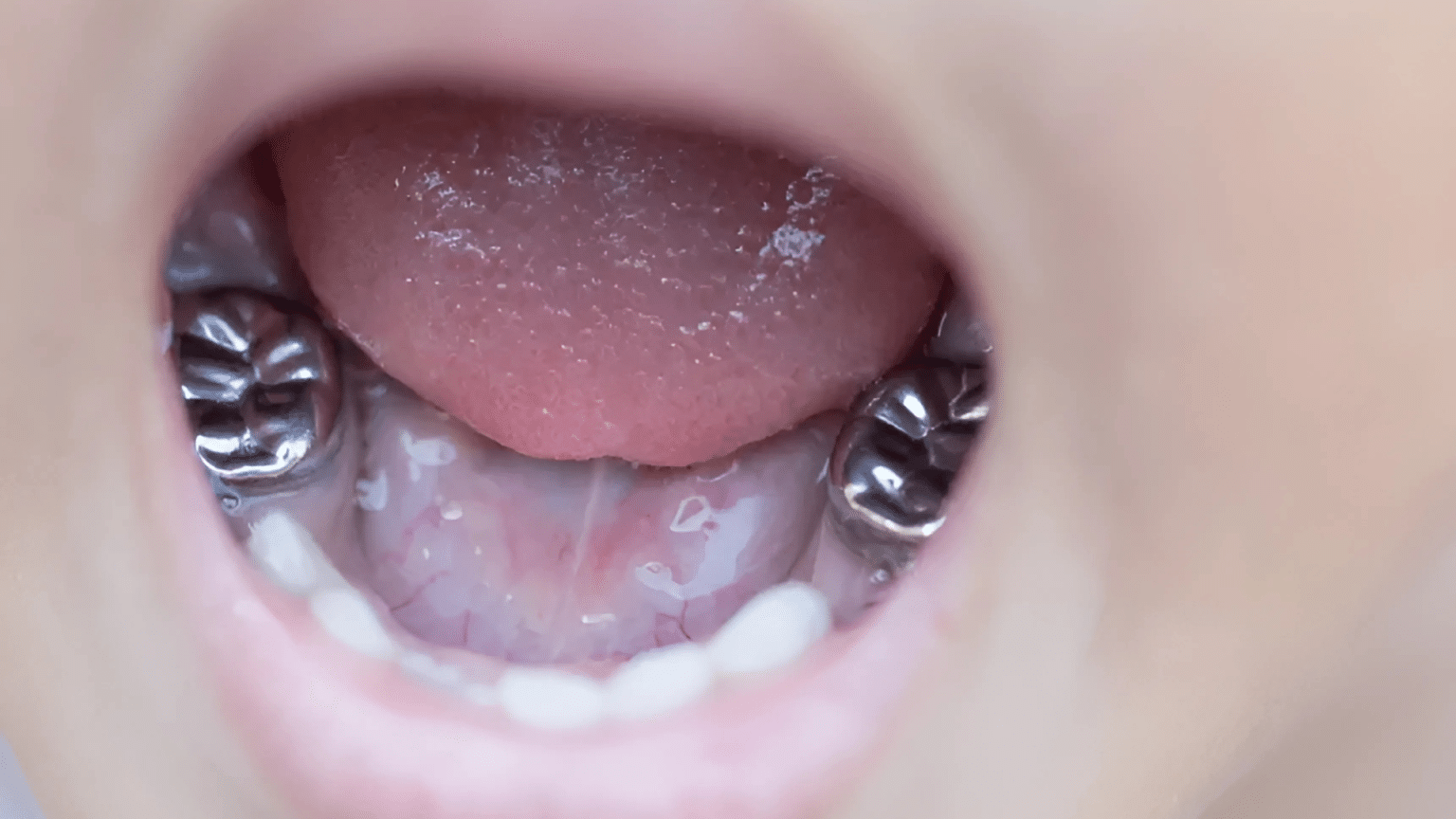 Why Kids Get Silver Teeth and How They Help - Freddy The Frogcaster